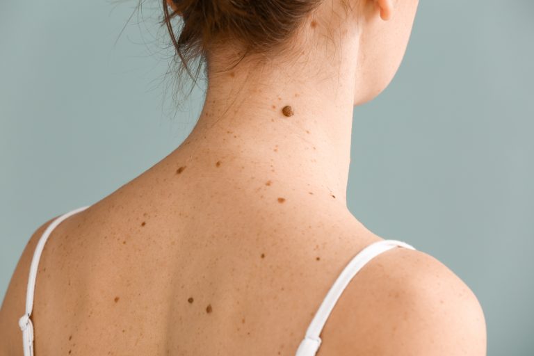 Cosmetic Mole Removal - Skin Deep Cosmetic Clinic