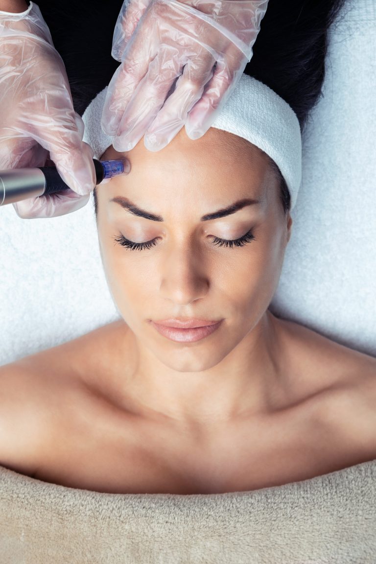 Treatment Spotlight: Micro Needling - Skin Deep Cosmetic Clinic